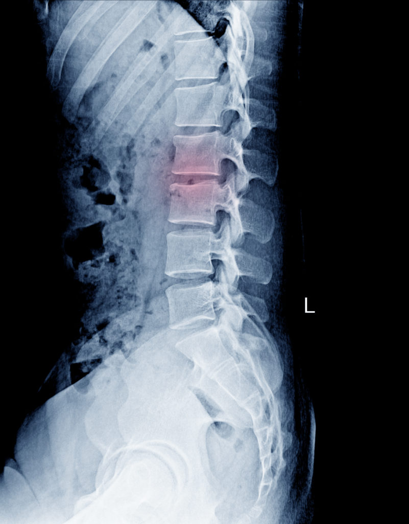 L-S Spine(Lumbo-SACRAL) AP. - Frisco Spine
