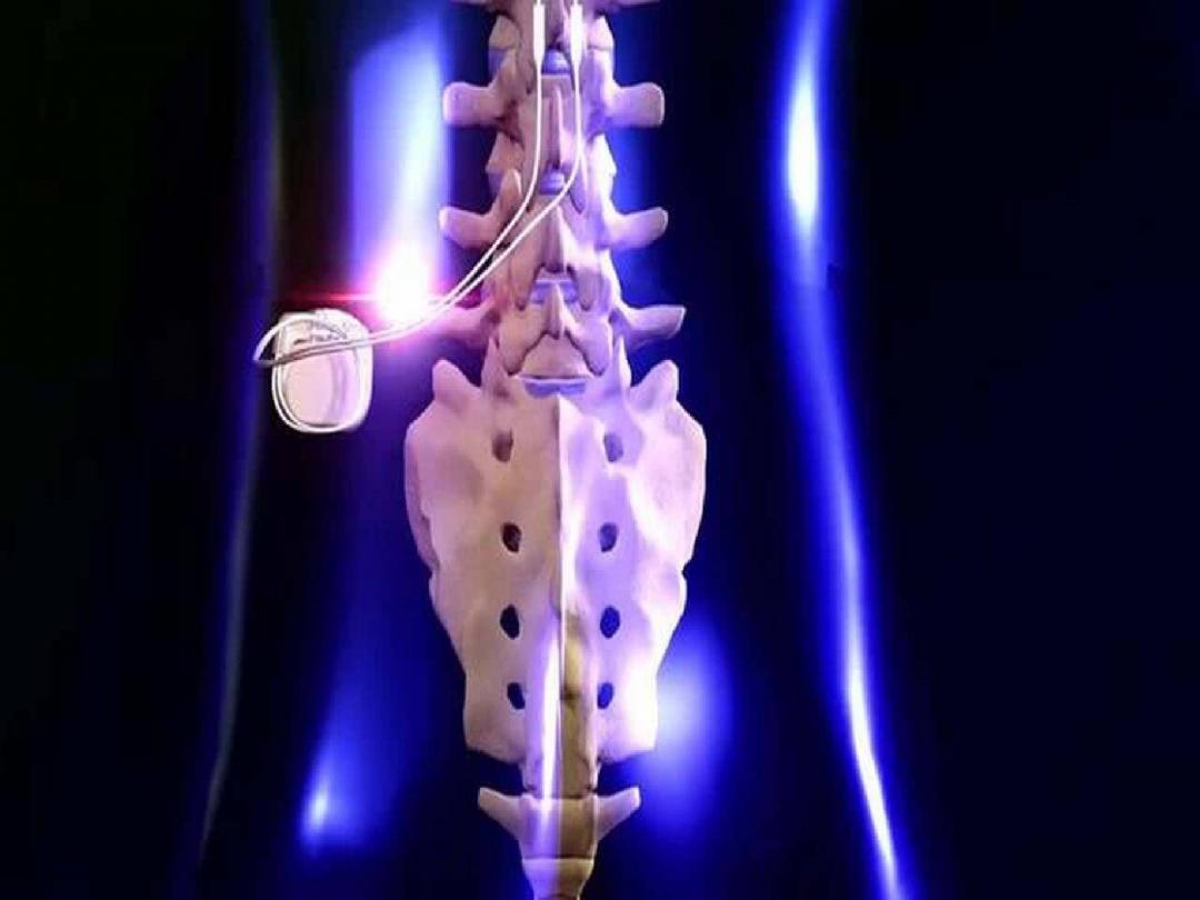 1600x1200-Neuromodulation - Frisco Spine