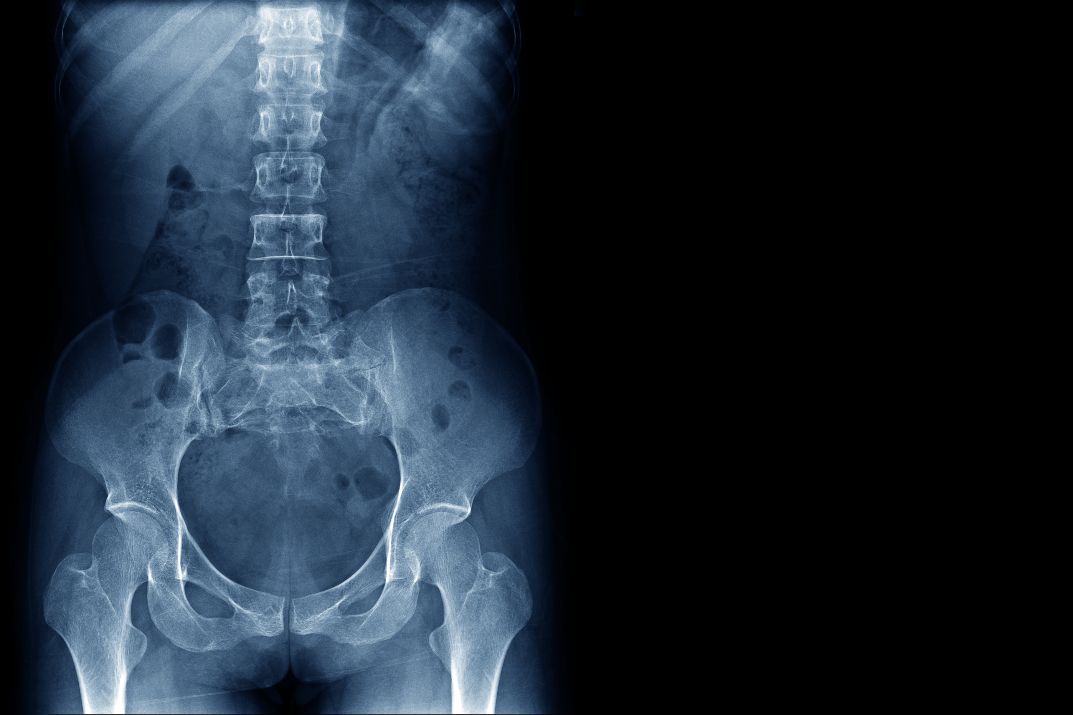 X ray Image Of Human Normal Spine Rips Pelvis Both Hip Joint And X ray Image Of Human Normal Spine Rips Pelvis Both Hip Joint And